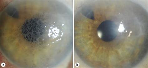 Reticular Bullous Epithelial Corneal Edema After Netarsudil Use For