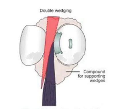 Double Wedging فرهنگ تفصیلی دندانپزشکی