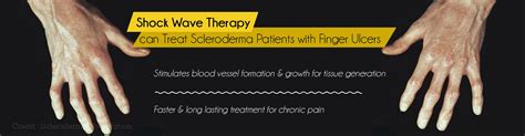 Shock Wave Therapy Can Treat Finger Ulcers In Scleroderma Patients