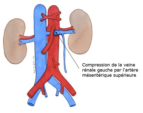 Traitement Ostéopathique Des Syndromes De Compression Vasculaire Au