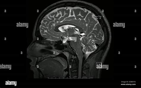 Sagittal Mri Brain Labeled At Jean Spadafora Blog