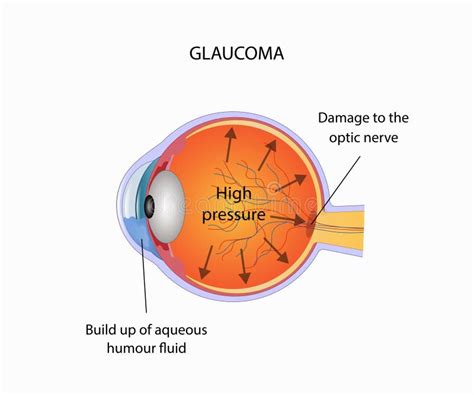Eye With Glaucoma Medical Infographic With Anatomy Of The Human Eye