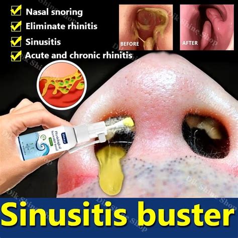 Jual Nasal Spray Semprotan Hidung Obat Polip Hidung Air Laut Fisiologis