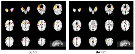 top ten most discriminative brain regions selected by ggml method using