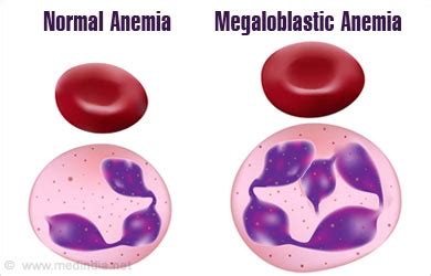 Megaloblastic Anemia Causes Symptoms Signs Diagnosis Treatment