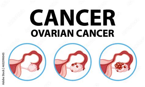 Medical Anatomy Infographic Womans Ovarian Cancer Awareness Stock