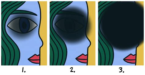 Macular Degeneration Progression Community Views