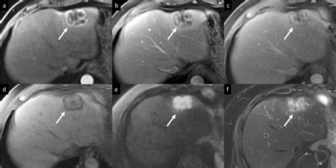 a surgically proven combined hepatocellular cholangiocarcinoma in a