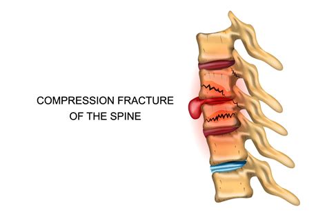 Compression Fracture Vertebral Compression Fracture Treatment In