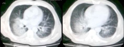 Chest Computerized Tomography Chest Computerized Tomography Download Scientific Diagram