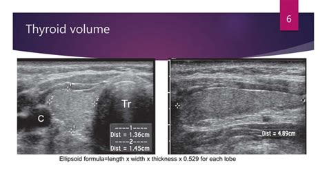Approach To Thyroid Mass Pptx