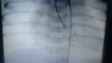 Dr Sherine Abdelsalam On Linkedin Neonate Critical As With Severely