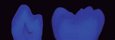 For Esthetic Reasons The Anterior Teeth Are The Most Used Examples Of Download Scientific