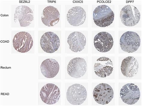 Integrating ScRNA Seq And Bulk RNA Seq To Characterize Infiltrating Cells In The Colorectal