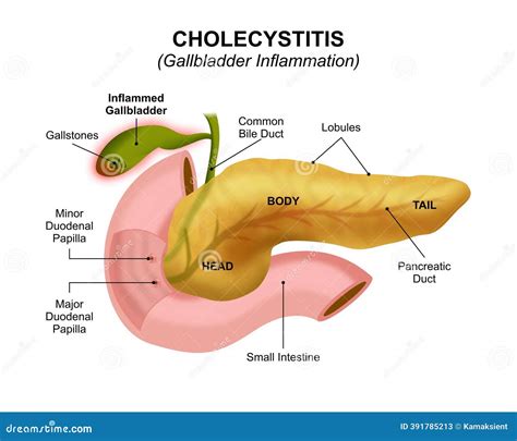 Cholecystitis As Gallbladder Inflammation From Gallbladder Outline