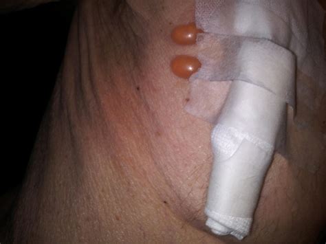 Kidney Failure