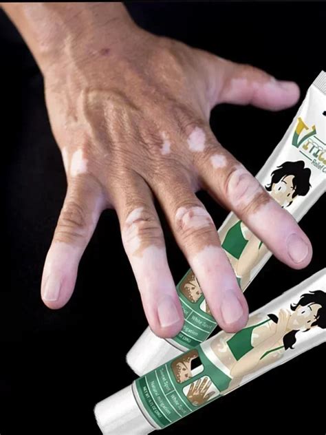 Экстракт Vitiligo травяная мазь удаление шприца удаление белых пятен устранение кожи Vitiligo