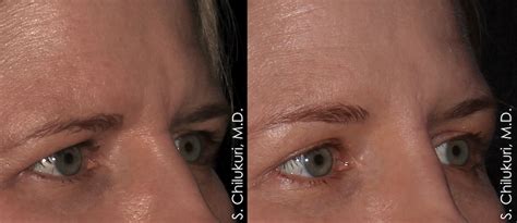 Neuromodulators 6 Refresh Dermatology