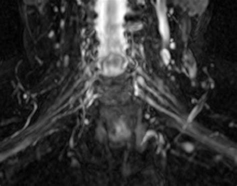 Imaging The Anatomy Of The Brachial Plexus Review And Self Assessment