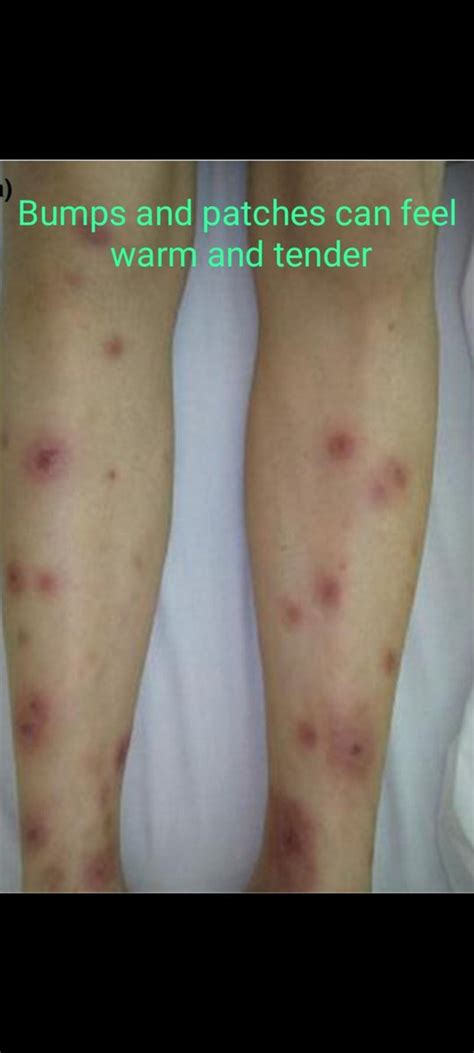 📍erythema 𝗺𝗮𝗿𝗴𝗶𝗻𝗮𝘁𝘂𝗺 Vs 📍erythema 𝗺𝗶𝗴𝗿𝗮𝗻𝘀 Vs 📍erythema 𝗶𝗻𝗳𝗲𝗰𝘁𝗶𝗼𝘀𝘂𝗺 Vs 📍