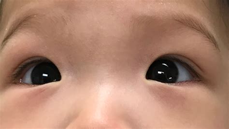 Pseudostrabismus Eyewiki