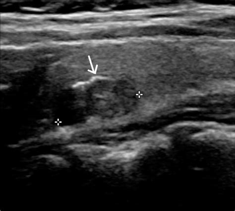 Validation Of Tirads Acr Risk Assessment Of Thyroid Nodules In