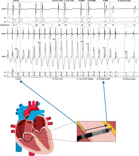 Electrophysiological Characteristics Of Lead Positiondependent