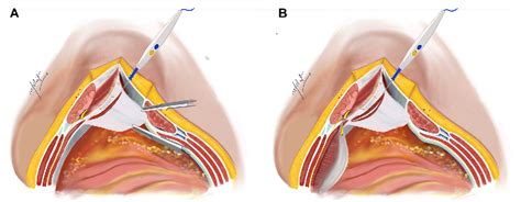 Figure 2 From Posterior Component Separation Technique—original Transversus Abdominis Release