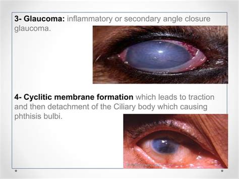 Uvitis Opthalomology Ppt