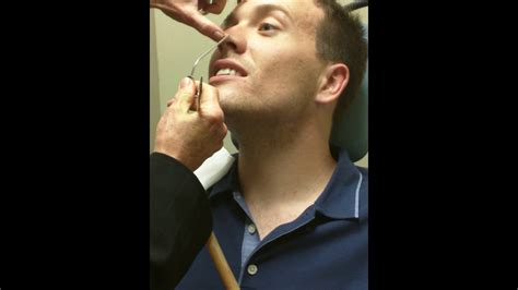 Post Septoplasty Splint Removal Youtube
