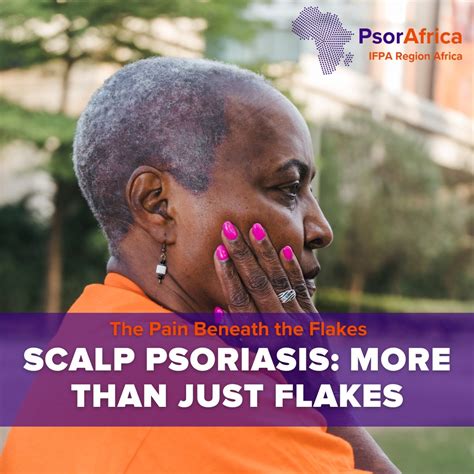 Psoriasis Its Just Dandruff Right” Wrong Scalp Psoriasis Is Far More Than A Cosmetic