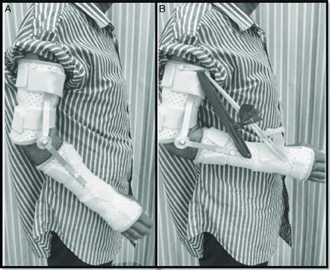 Dynamic Assist Orthosis To Augment Muscle Funciton For Example Double