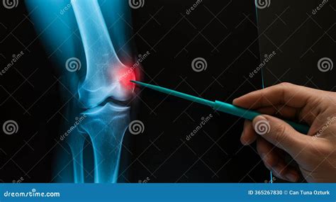 Understanding Hip Bone Spurs Detailed Visuals Reveal Structure Growth
