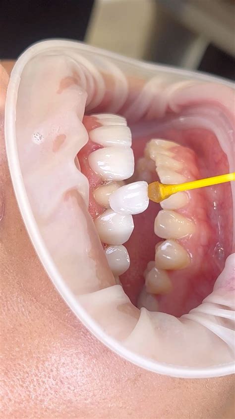 Minimal Prep Veneers Video Healthy Teeth Teeth Whitening Implant Dentistry