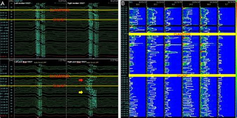 Intraoperative Neurophysiological Monitoring During Carotid Download Scientific Diagram