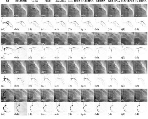 Figure 7 From Robust Implementation Of Foreground Extraction And Vessel