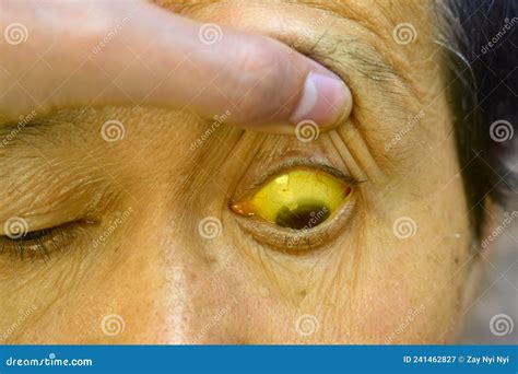 Yellowish Discoloration Of Skin And Sclera Or Deep Jaundice In Face Of