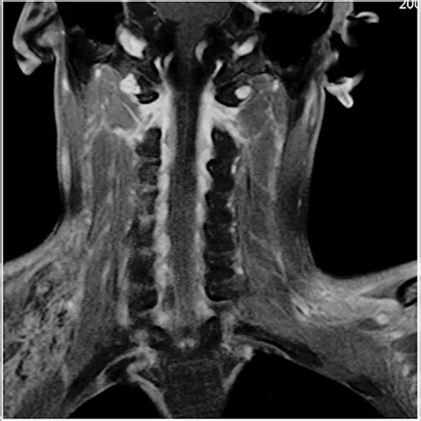 Mri Cervical Spine C Brachial Plexus Scan Cost In Delhi Test Price Near