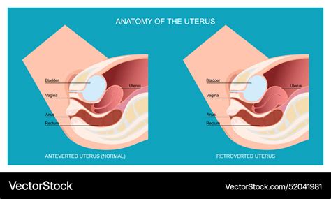 An Anteverted Uterus Different Than A Retroverted Vector Image
