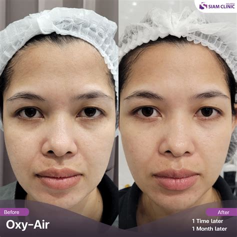 Acne Treatment Before And After Photos Siam Clinic Thailand