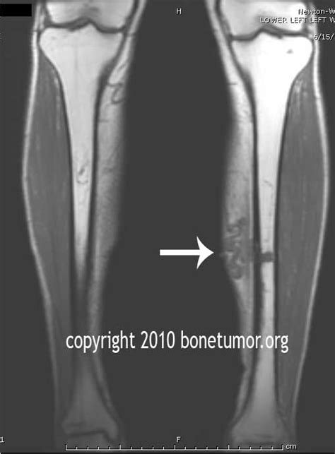 A Vascular Mass On The Front Of The Tibia