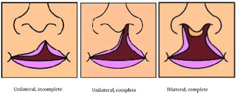 Cleft Lip Classification Download Scientific Diagram