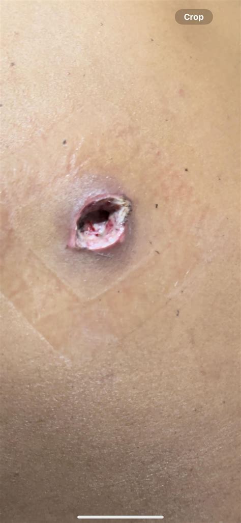 Just Had An Abscess Removed From Back Rpopping