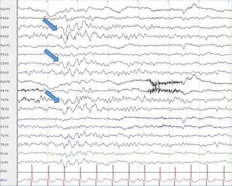 Superimposed Bilateral Occipital Spikes In Generalized Rhythmic Delta