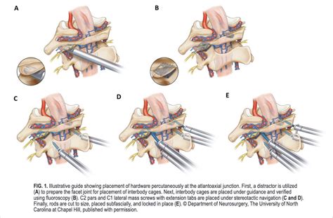 Gene Hobbs On Linkedin “minimally Invasive Modification Of The Goel
