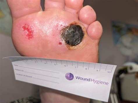 Pyoderma Gangrenosum In My Mothers Leg Pt 2 More Info In Comments