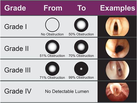 Subglottic Stenosis Otolaryngologic Clinics Of North America