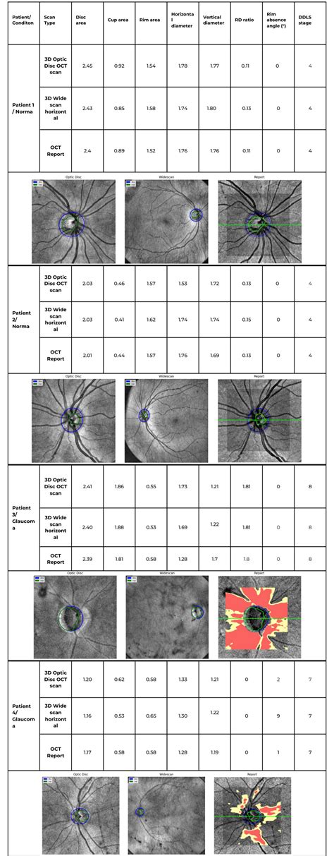 Ai Oct Optic Disc Analysis For Assessing Risk Of Glaucoma