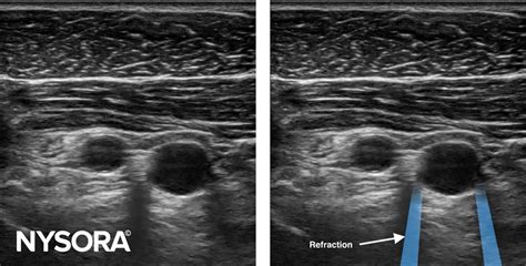 Ultrasound Image Artifacts Explained Nysora