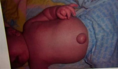 Abnormal Abdomen Findings Flashcards Quizlet